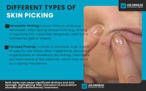 Excoriation Disorder/ Dermatillomania/ Skin-picking Disorder: Symptoms ...